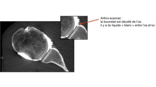 Pathologie du bourrelet - Lésion SLAP - Clinique de l'épaule & du coude